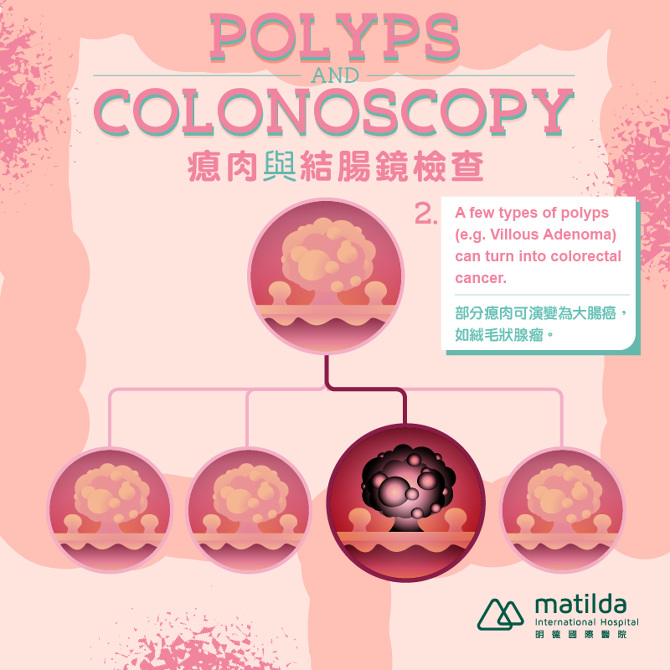 design/2019/infographics - Polyps and colonoscopy - leo cheung