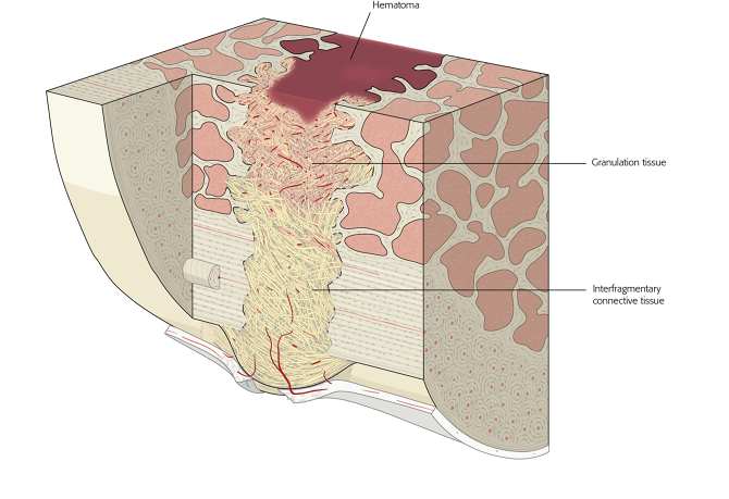 Prozess der sekundären Knochenheilung - Minks –– Illustration und Grafik