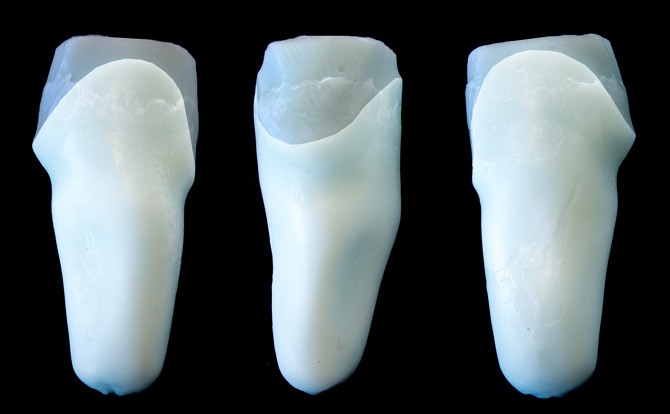 Prosthetic Socket - nomadicform