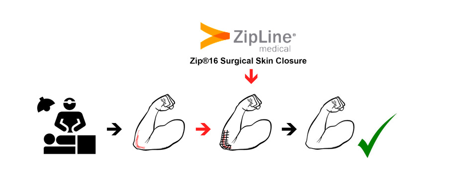 Zip 8 / 16 Surgical Skin Closure - Future Health Systems