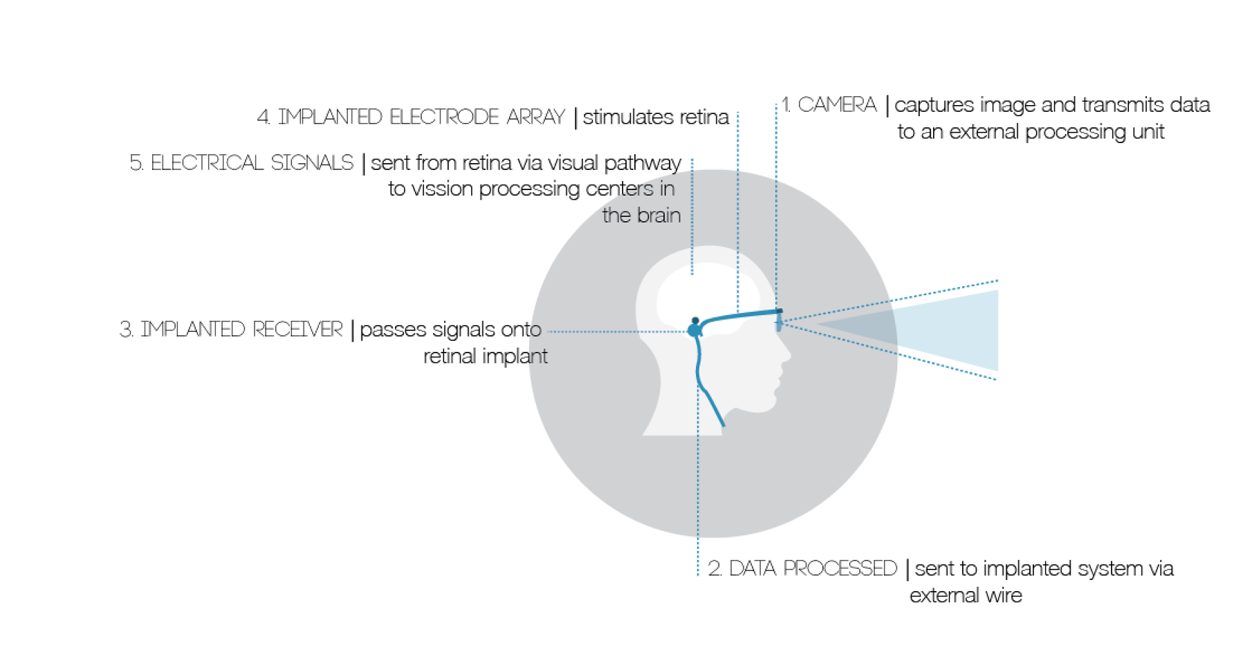 Argus II Retinal Prosthesis System - Future Health Systems