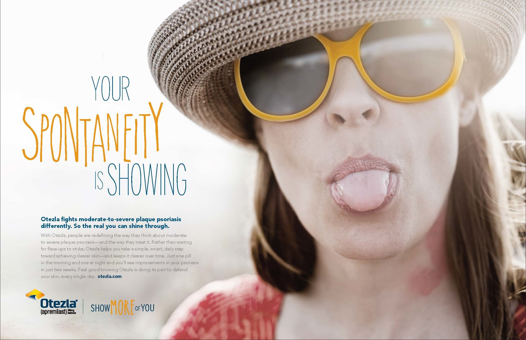 Otezla Plaque Psoriasis - valeriapharma