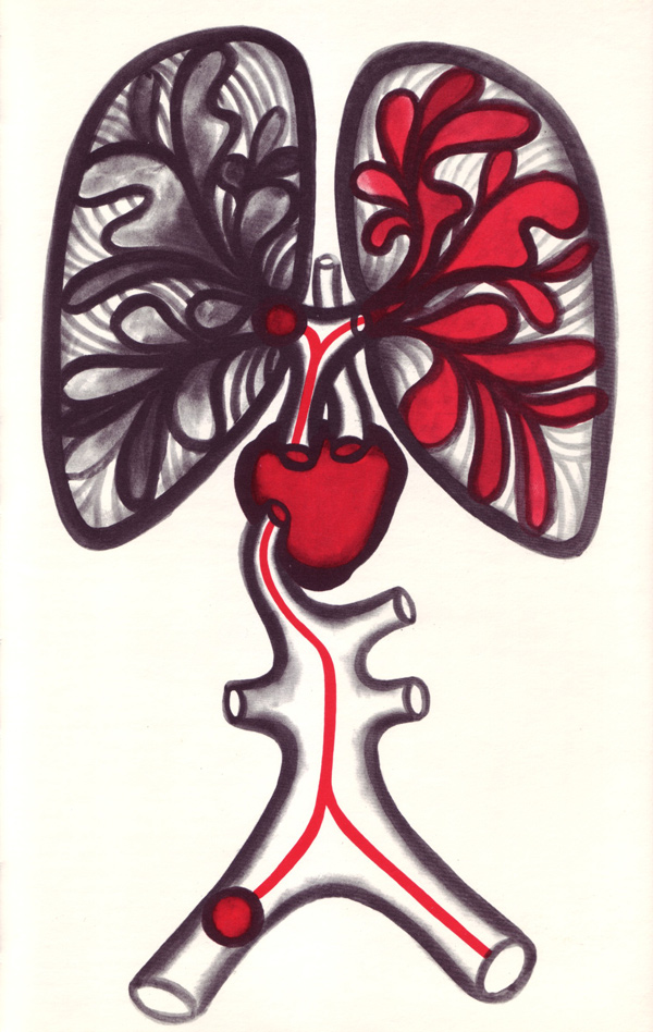 Embolie pulmonaire; infarctus du poumon; infarctus pulmonaire; thrombo ...