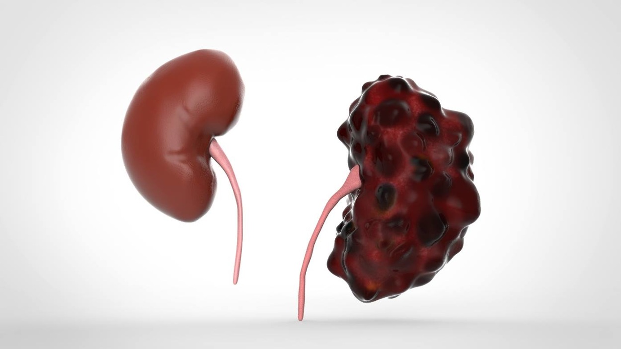 Polycsytic Kidney Disease - Liz Paton Medical Art